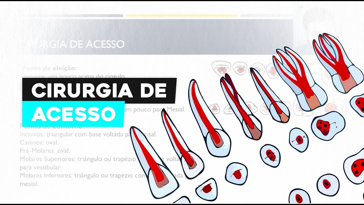 Cirurgia de Acesso Endodôntico: Guia Completo para Dentistas Iniciantes ...