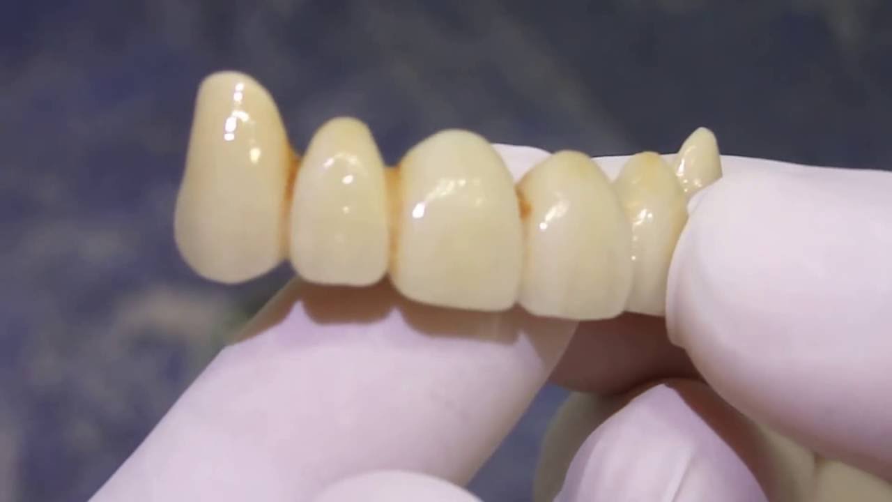 Elegancia Diferente Mejorar Puente De Ceramica Dental Bebida Cuatro elegancia-diferente-mejorar-puente-de-ceramica-dental-bebida-cuatro