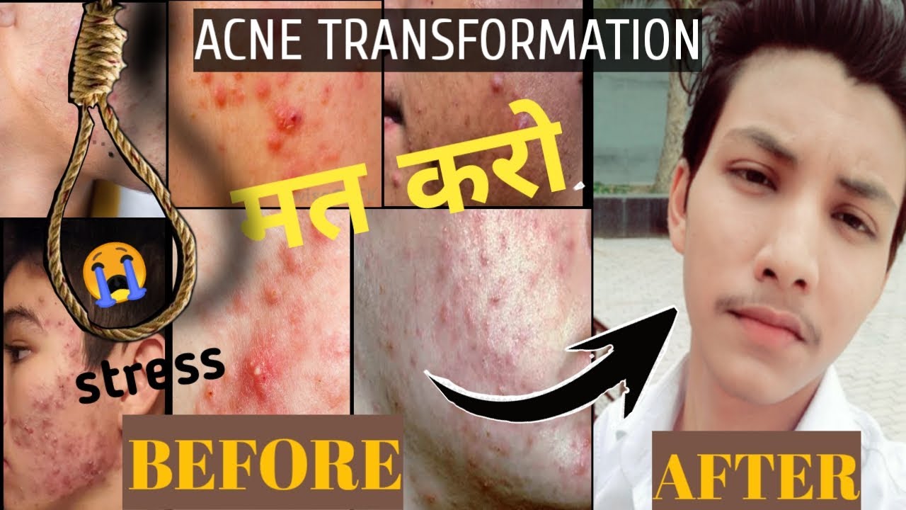 Acne Changed My Life | MY ACNE TRANSFORMATION IN 30 DAYS | MUST WATCH ...
