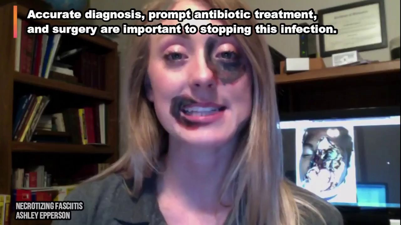 My Flesh Eating Bacteria New Case In The United States Youtube