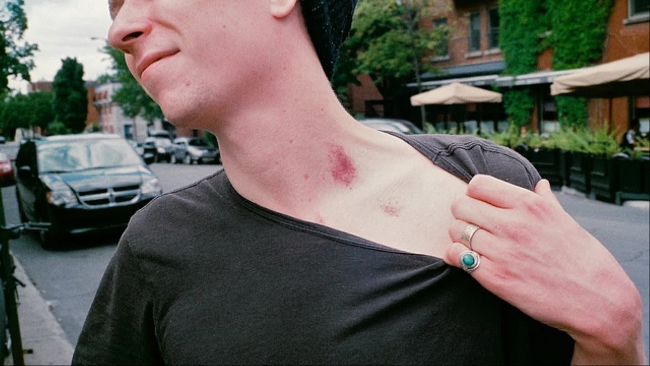 how to get rid of a hickey in 2 minutes - how to get rid of a hickey as ...