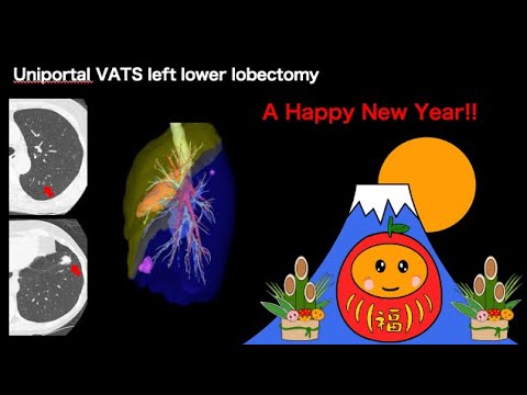 83】Uniportal VATS left lower lobectomy (LLL), almost non-edited version ...