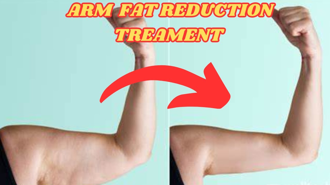 Arm Fat Reduction by NON-SURGICAL Liposuction by Dr. Atin Banerjee ...