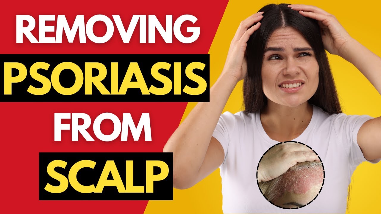 Removing psoriasis from scalp | How to get rid of scalp psoriasis - YouTube