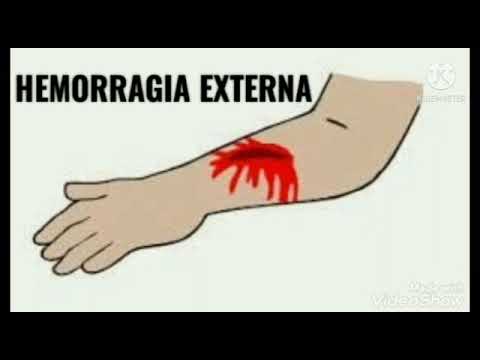 Hemorragia Externa