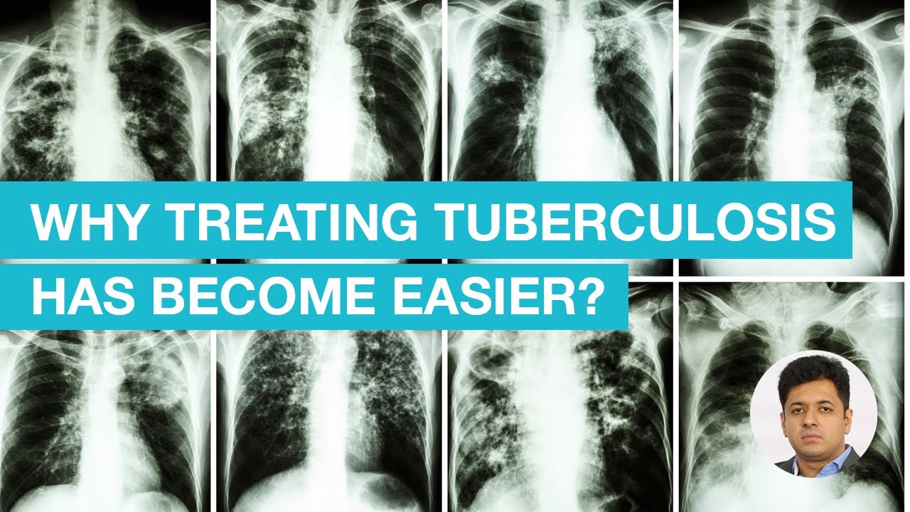 How to treat (TB) tuberculosis? Know more! - YouTube