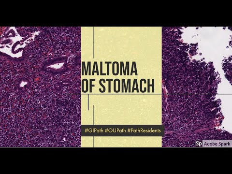 MALToma stomach1 - YouTube