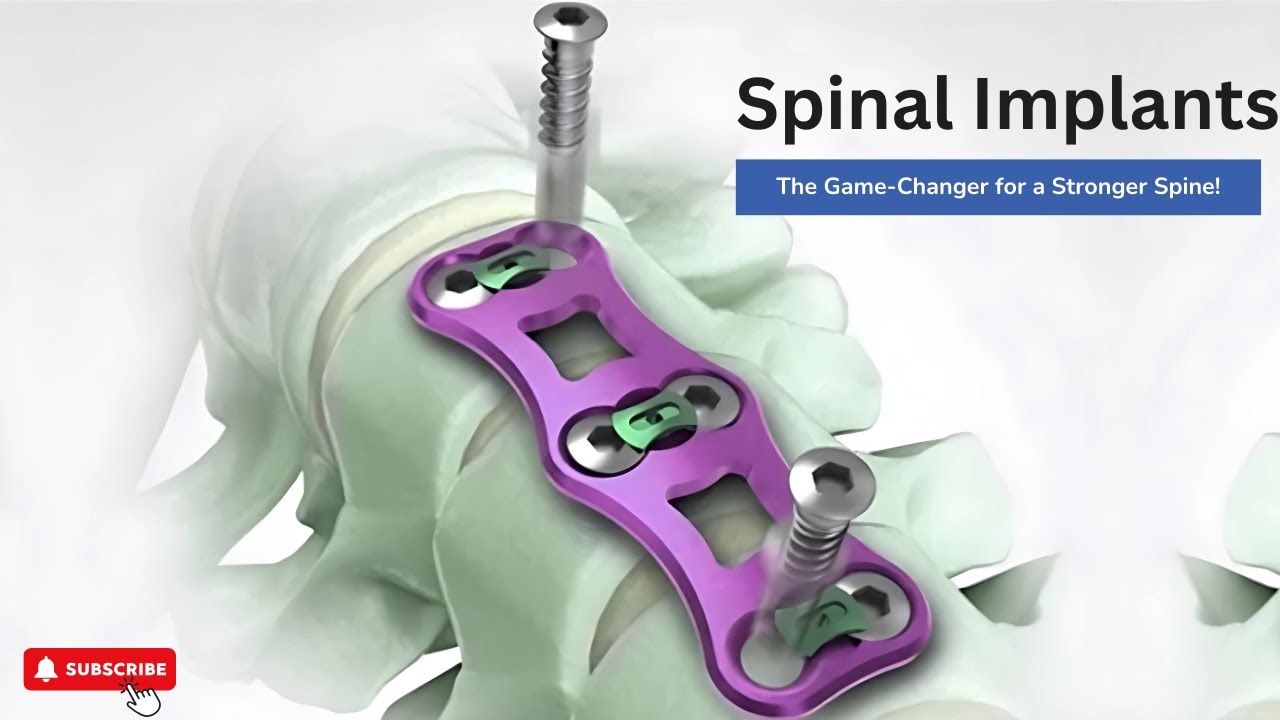 Spinal Implants: The Game-Changer for a Stronger Spine! #health #doctor ...