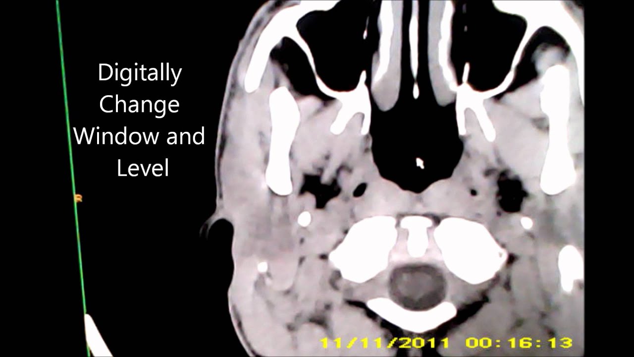 Normal CT Head CAT Scan of the head Practical review Using system - YouTube
