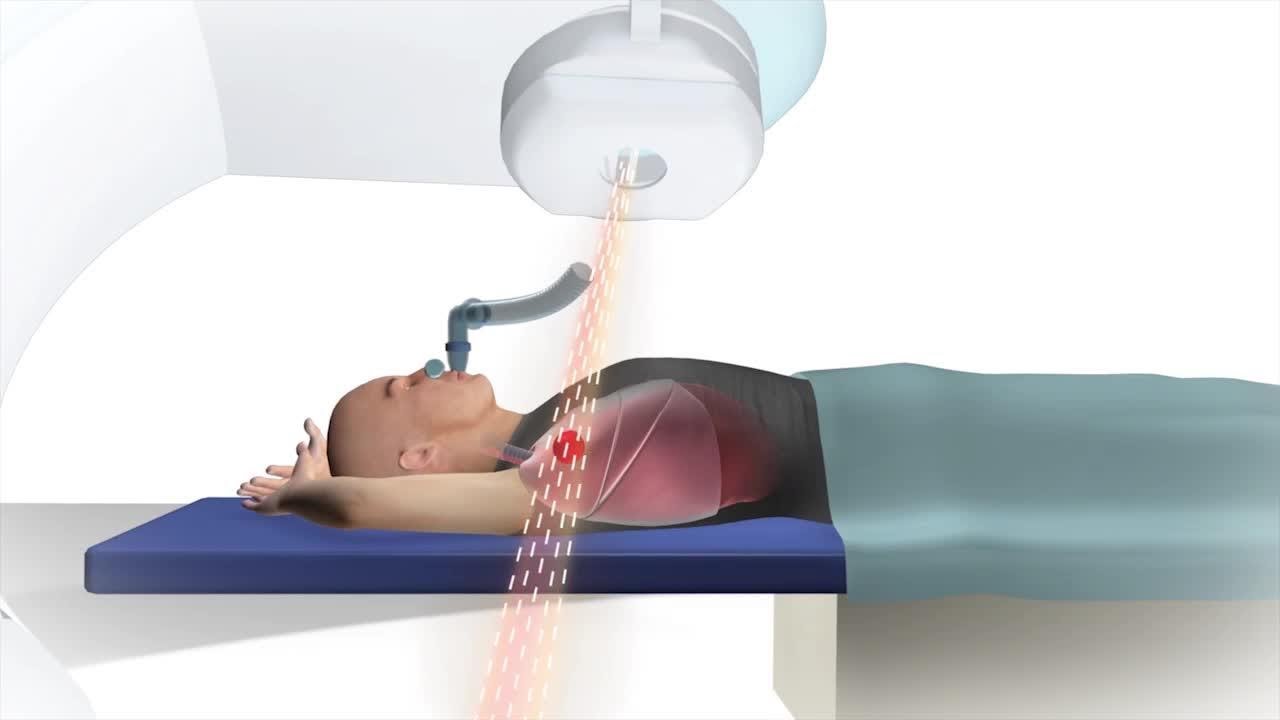 Active Breathing Coordinator (ABC) Device for Lung Cancer or Abdominal ...