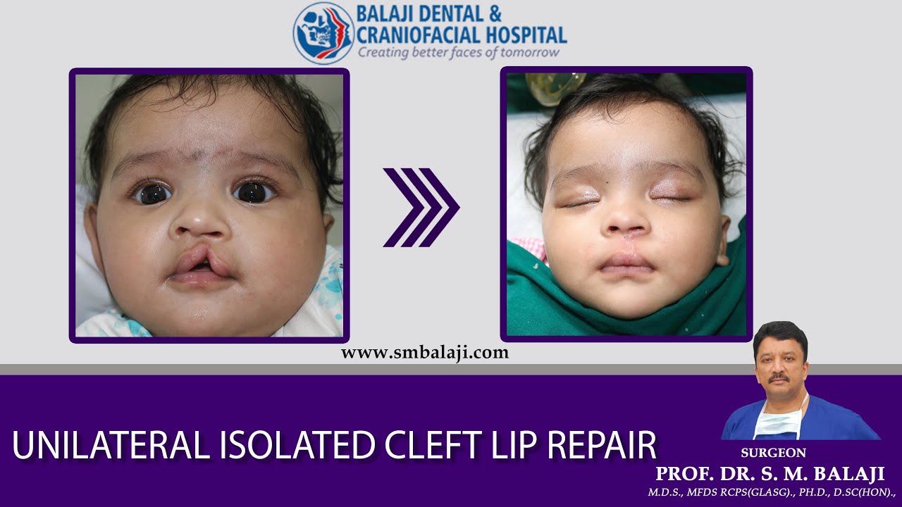 Unilateral Isolated Cleft Lip Repair Before And After Video - YouTube