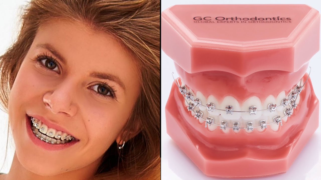 GC Rhodium Line Orthodontic Treatment - YouTube