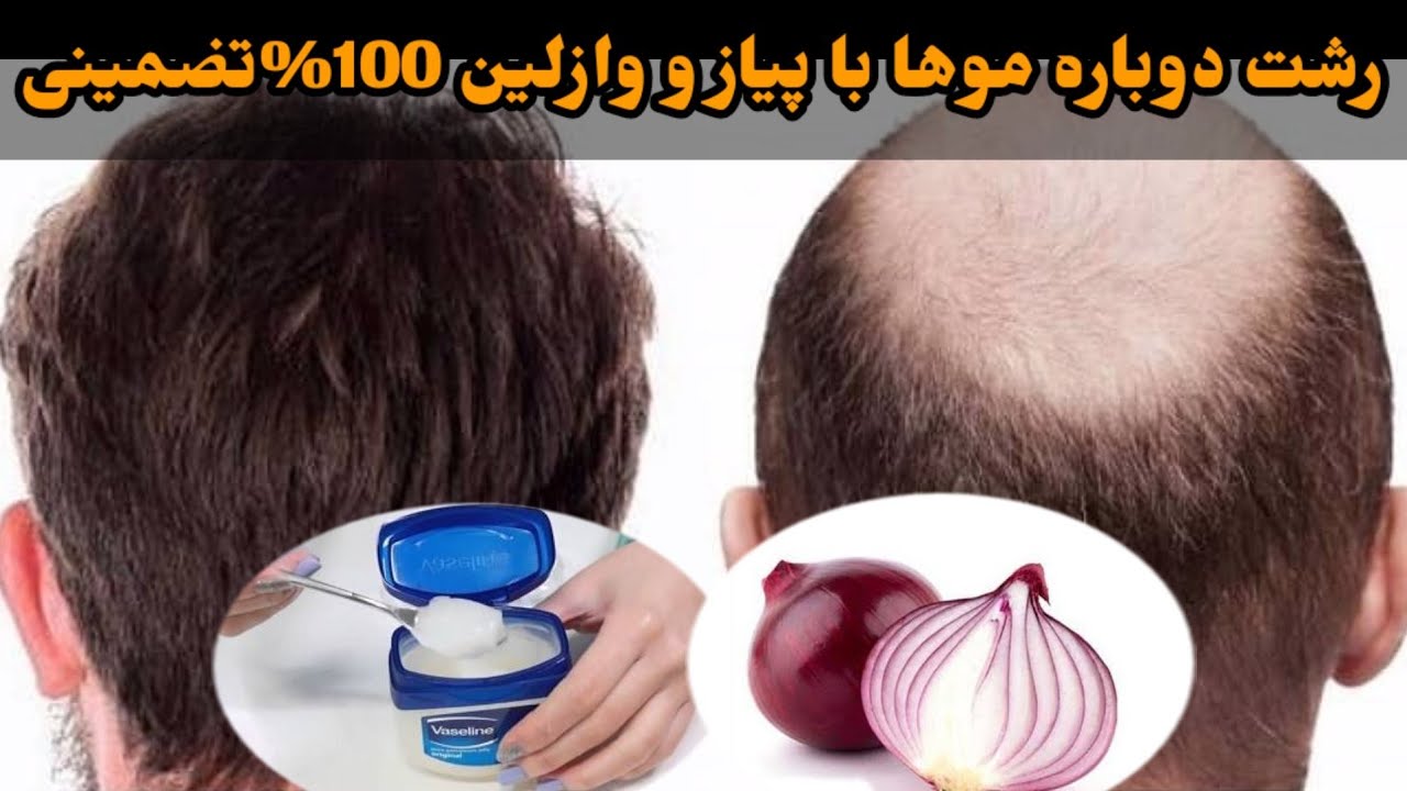 رشت دوباره موها با آب پیاز و وازلین %100 تضمینی #AFGtv - YouTube