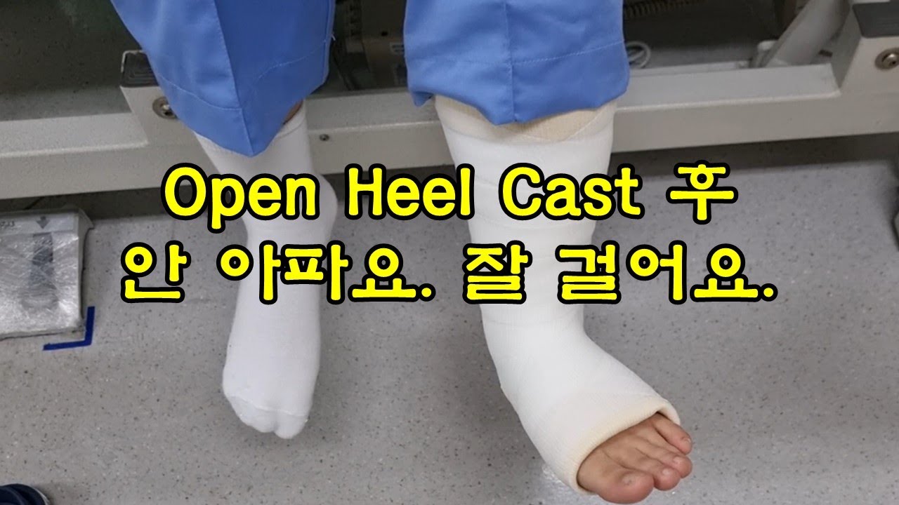 Open Heel Cast 후 통증없이 자연스러운 Walking - YouTube