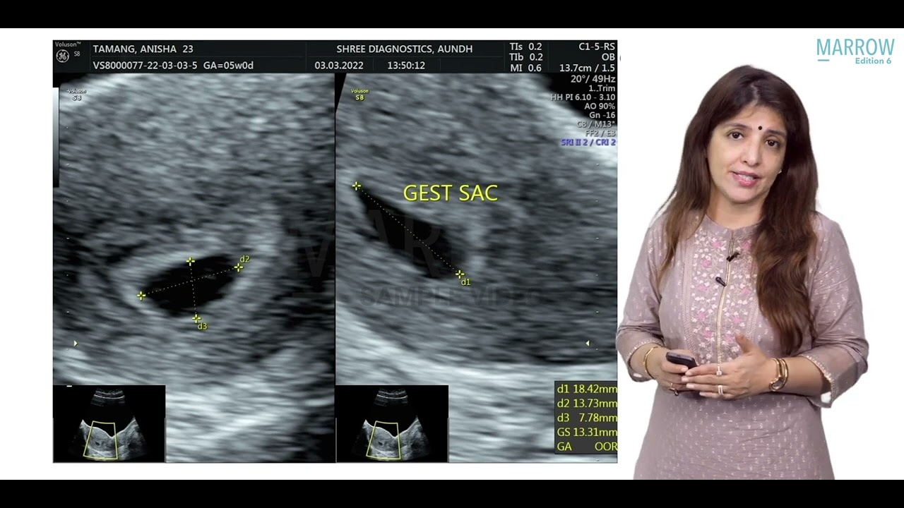 E6 Sample Video: Intrauterine pregnancy (OBG) - YouTube
