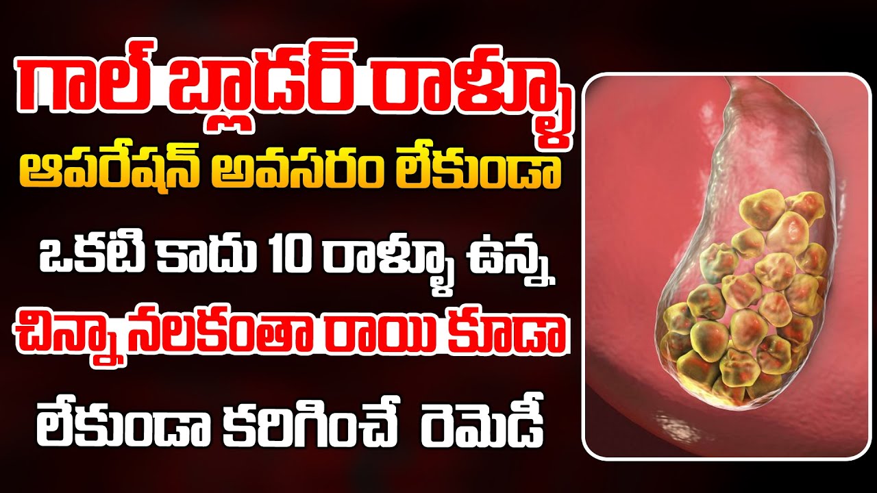 How to Remove Gallbladder Stones naturally|| పిత్తాశయంలో రాళ్ళు ...