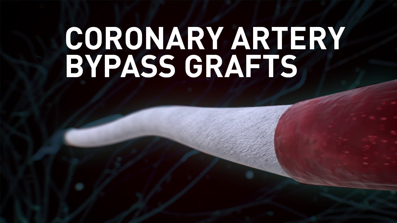 Endogeneous Tissue Restoration - Coronary Artery Bypass Grafts (CABG ...