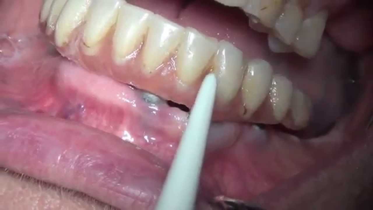 IMPLANTS MAINTENANCE - YouTube