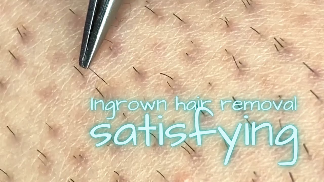 Satisfying Hair Plucking with Slimy Roots and Relaxing Music - YouTube