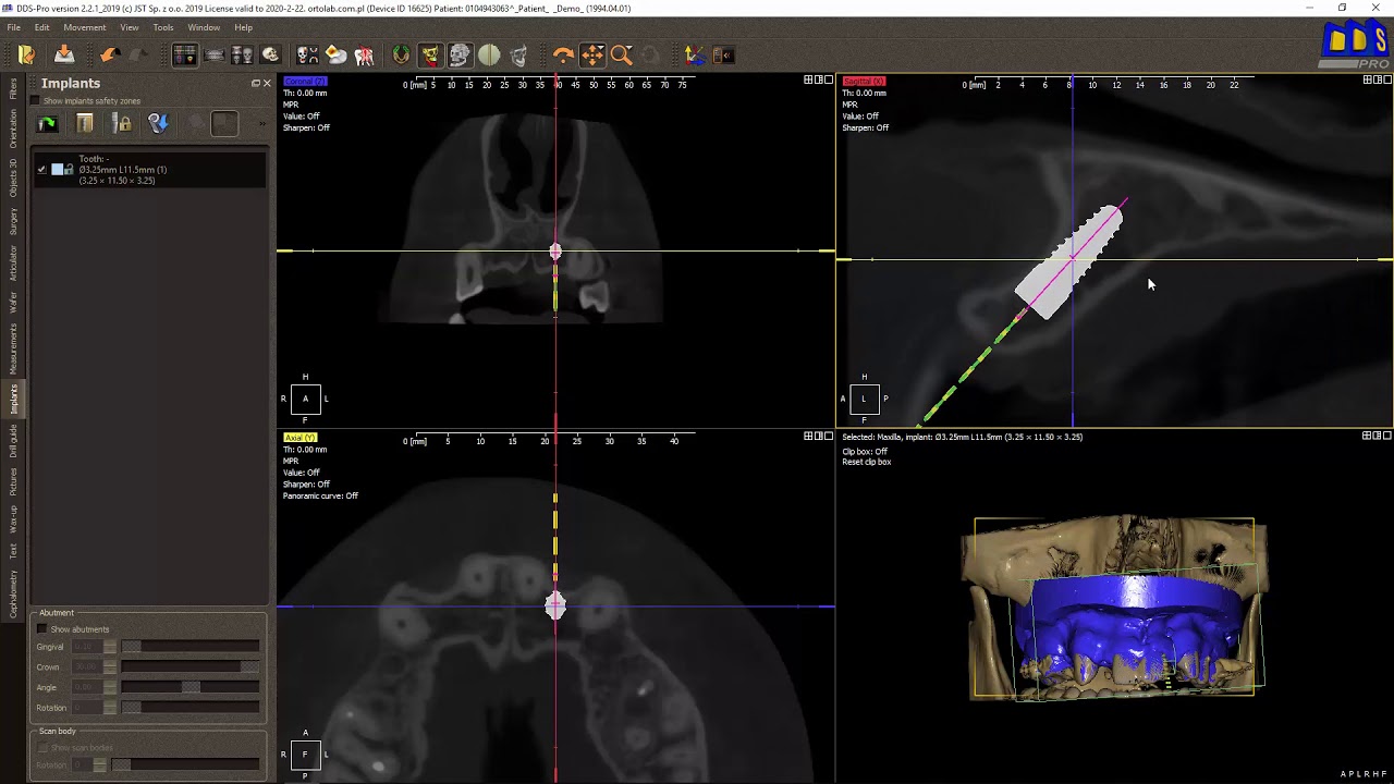 DDS Pro 009 Implant positioning - YouTube