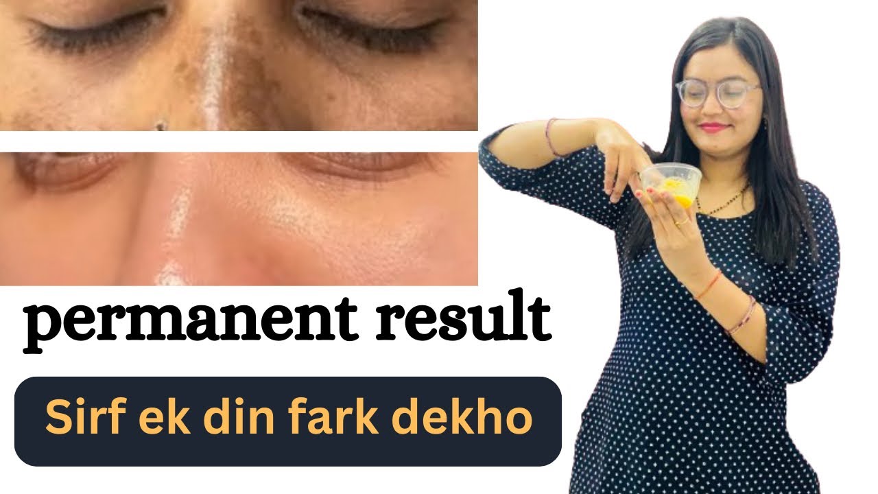 Melasma jhaiyan pigmentation ka permanent ilaj 😱 - YouTube