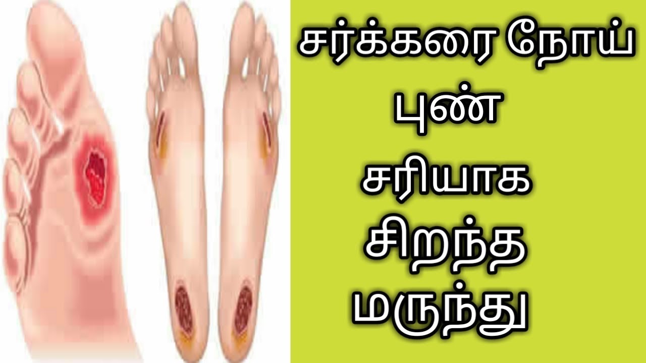 How to take care of feet by sugar patients!!! How to cure sugar ...
