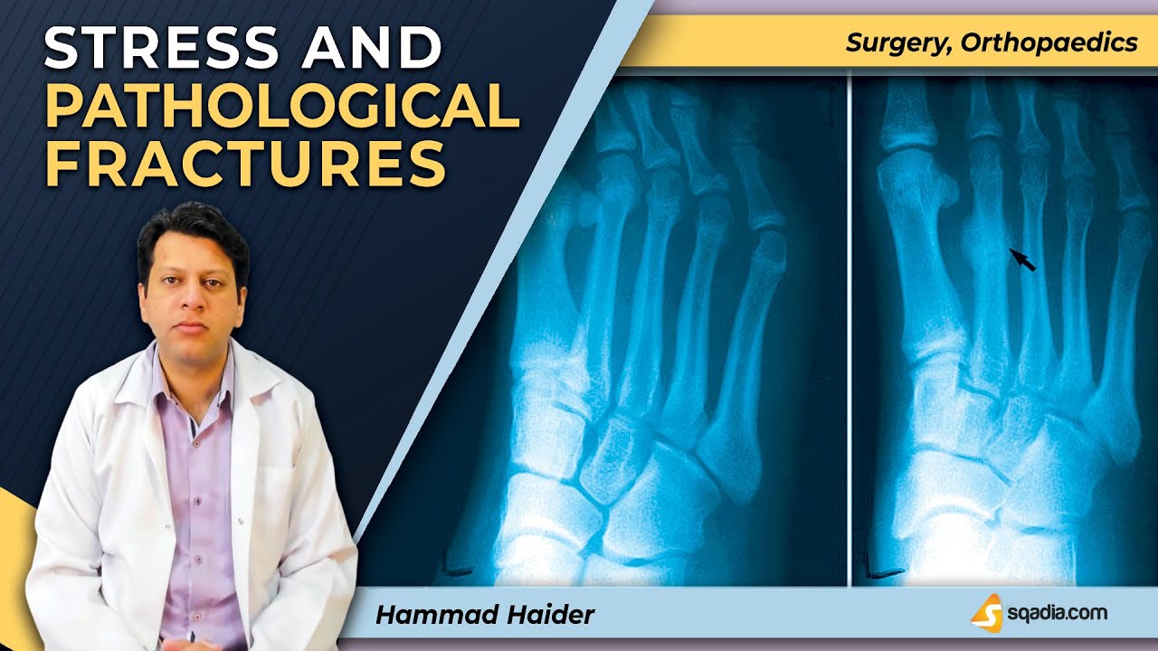 Stress and Pathological Fractures - Introduction - YouTube
