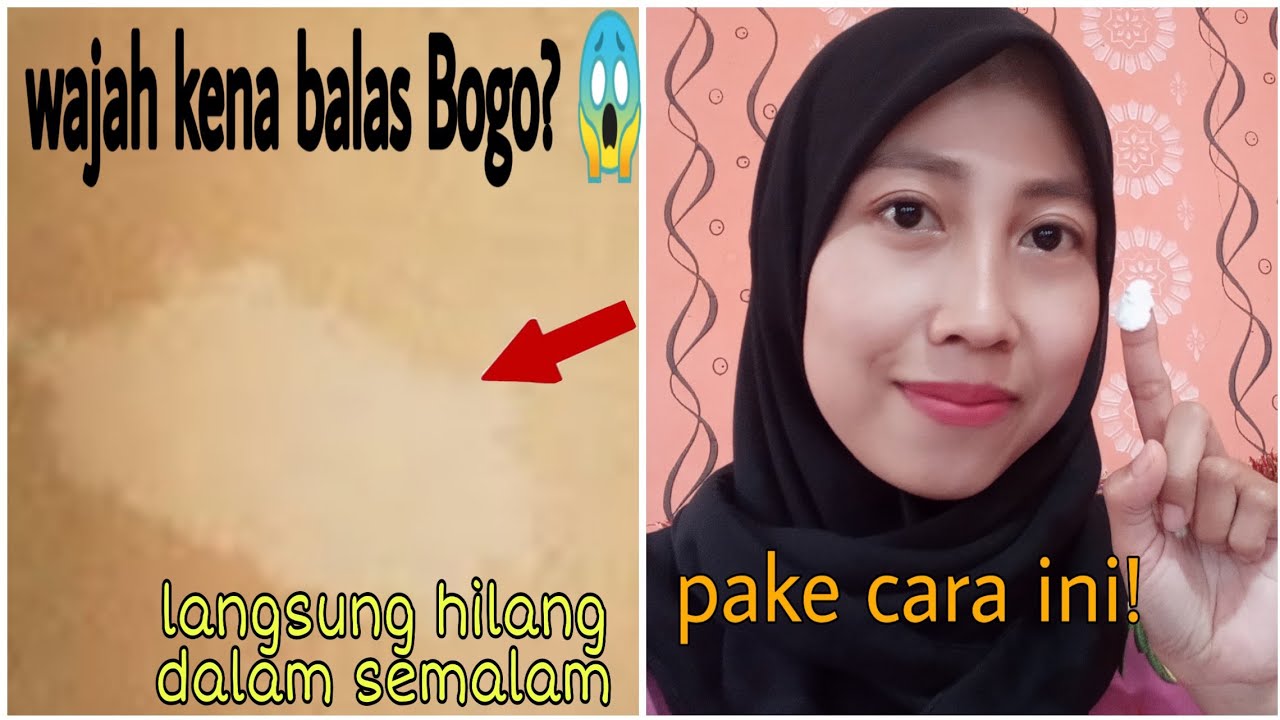 CARA MUDAH MENGHILANGKAN BERCAK PUTIH PADA WAJAH (balas bogo) - YouTube