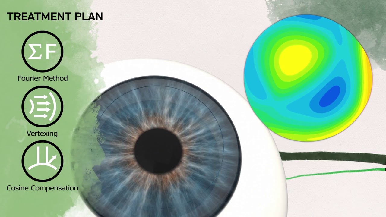 Ophthalmology Associates of the Valley | iDesign Refractive Studio ...