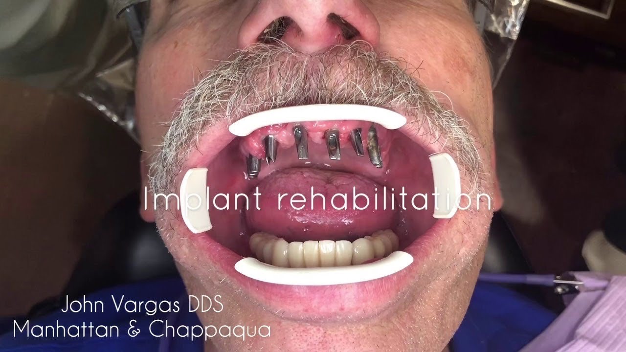 Dr. John Vargas : Full upper dental implant reconstruction. Cement ...