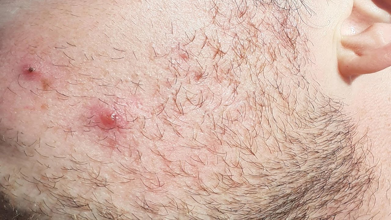 how to get rid of an ingrown hair EVERY SINGLE TIME - YouTube