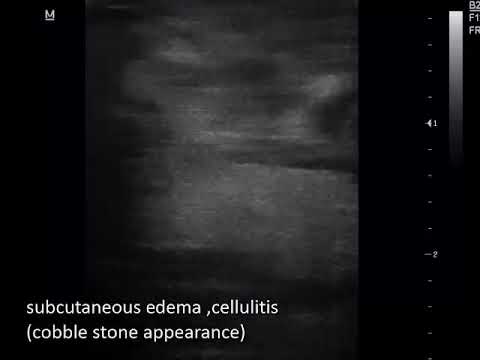 CASE 628 subcutaneous edema ,cellulitis cobble stone appearance - YouTube