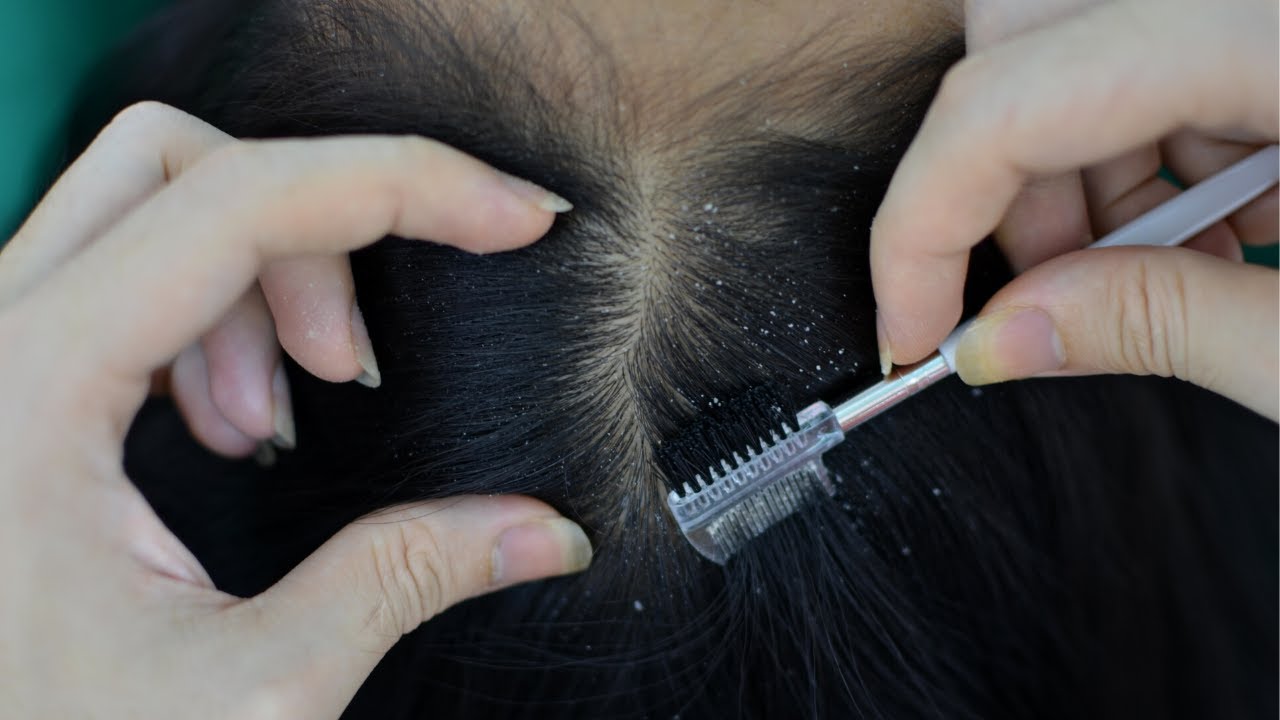 ASMR Scalp Treatment ( Scalp Check, Scalp Scratching, Head Scratching ...