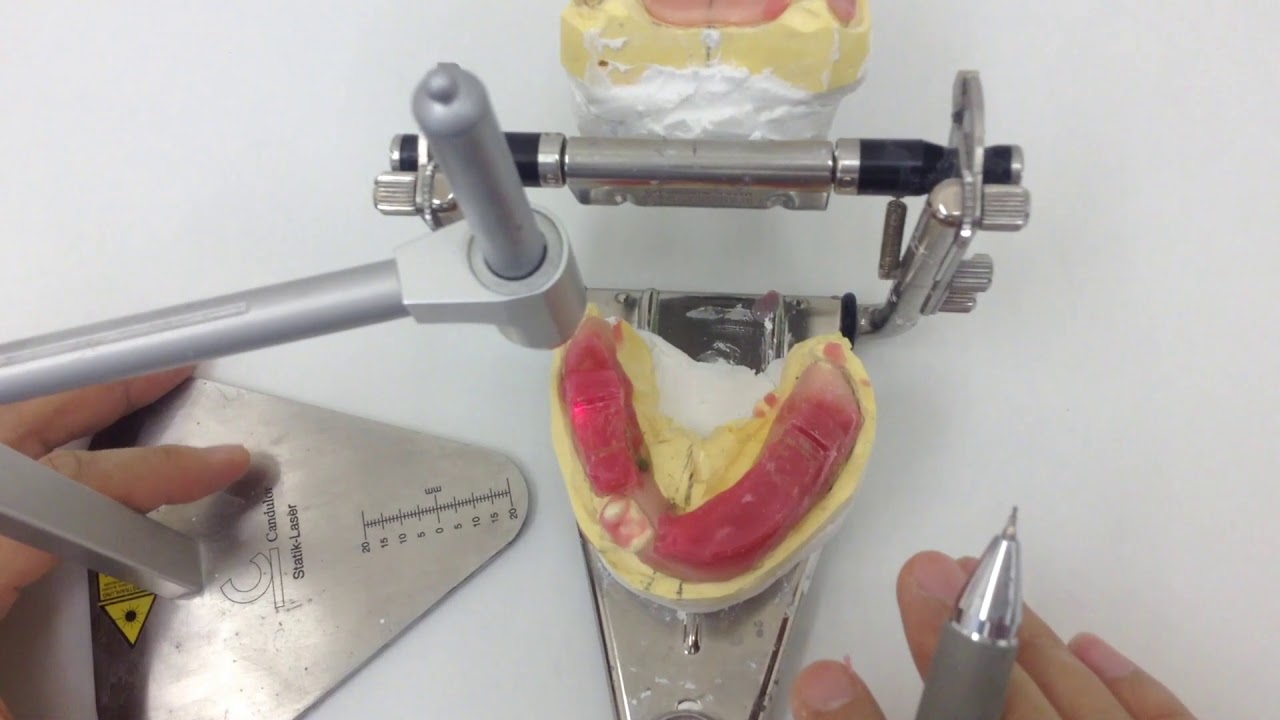 Static Pointer - How to use it in OM Denture System - - YouTube