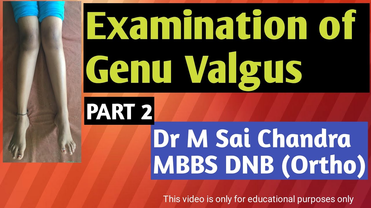 Examination of Genu Valgus Part 2 - YouTube