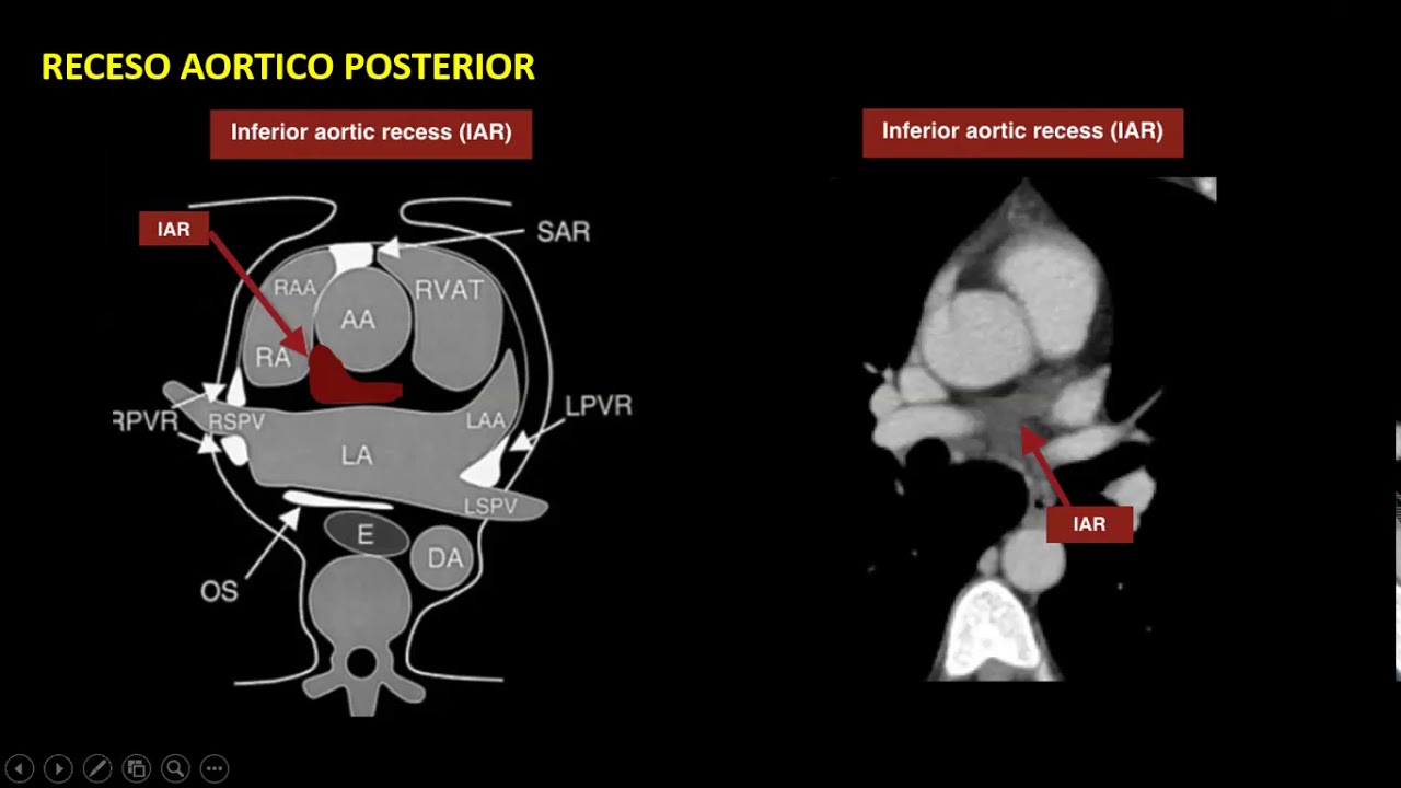 RECESOS PERICARDICOS. EVALUACIÓN POR TOMOGRAFÍA. - YouTube