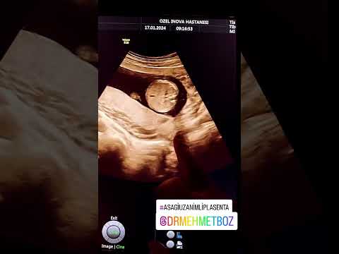 GEBELIKTE BEBEK ESININ COK ASAGIDA OLMASI. ASAGI UZANIMLI PLASENTA.  19. HAFTA GEBELIK