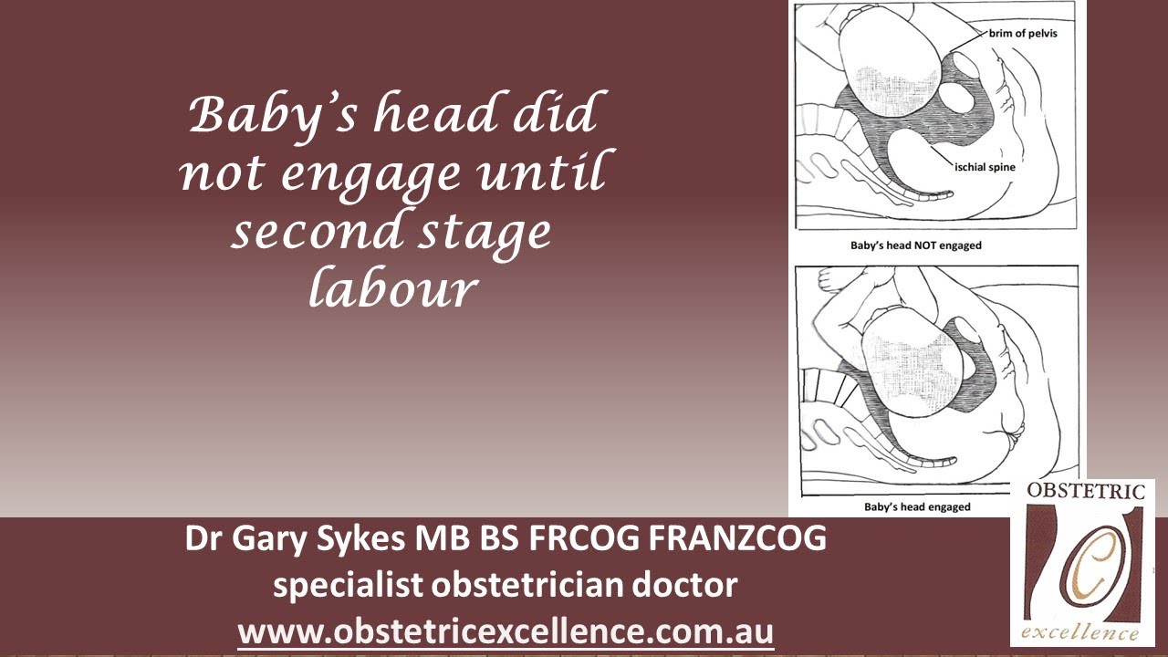 Baby's head did not engage until second stage labour - YouTube