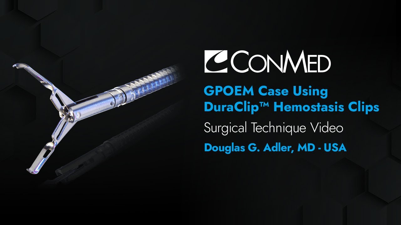 Dr. Douglas Adler - GPOEM Case Using DuraClip® Hemostasis Clips ...