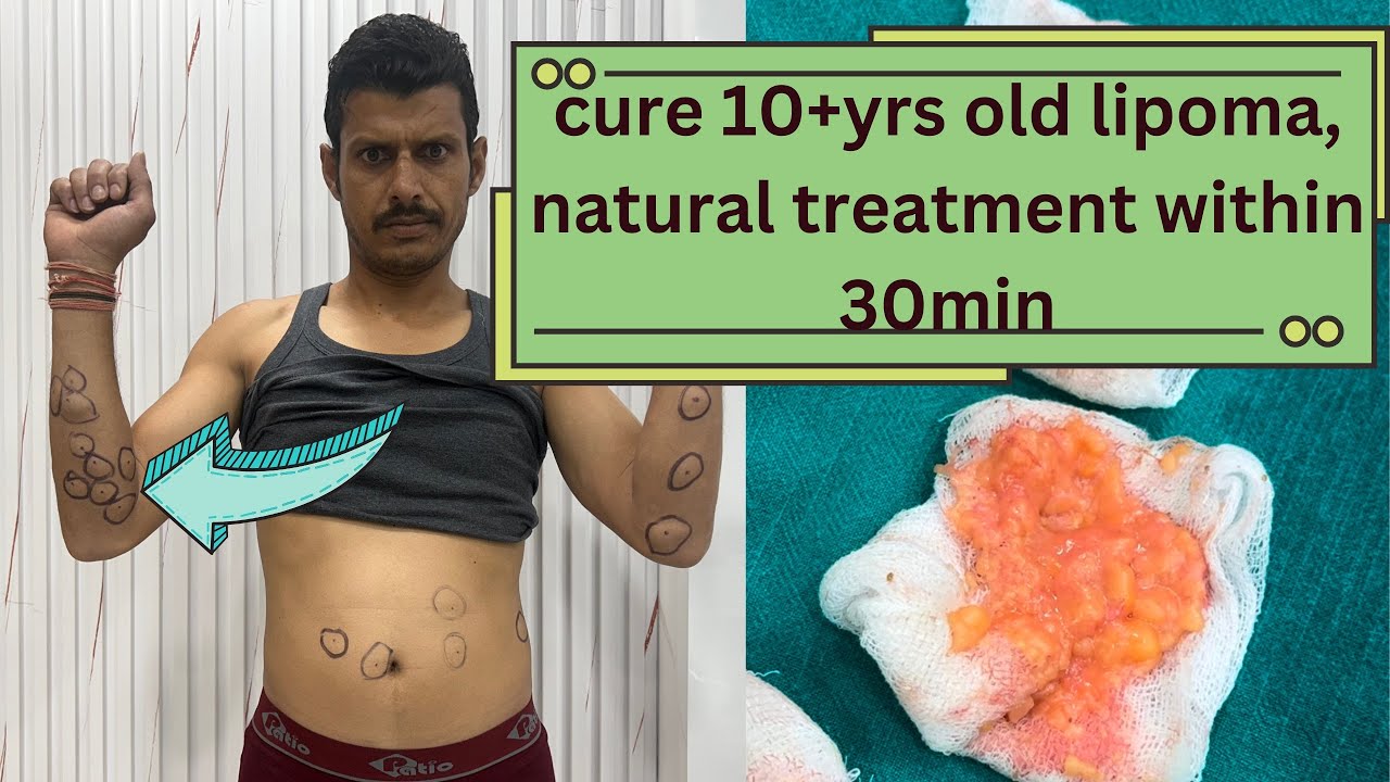 Lipoma Natural Treatment ! Lipoma Treatment ! Lipoma Removal Instant ...