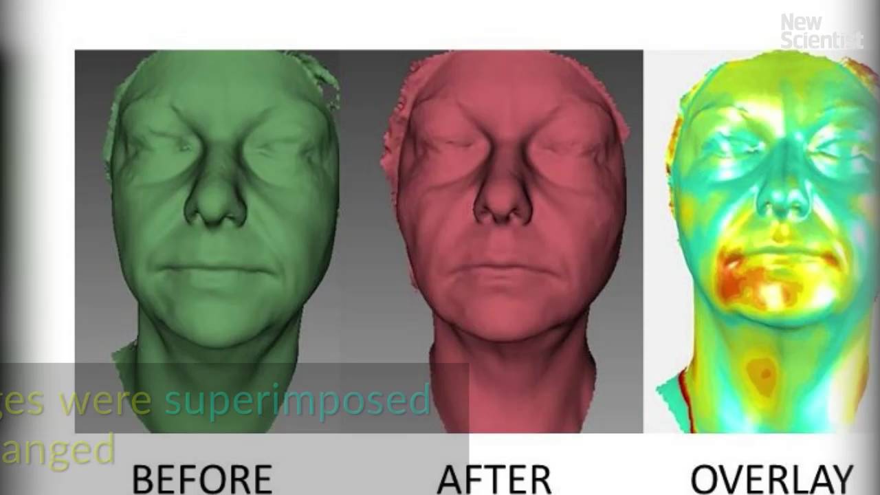 How will Botox change your face - YouTube