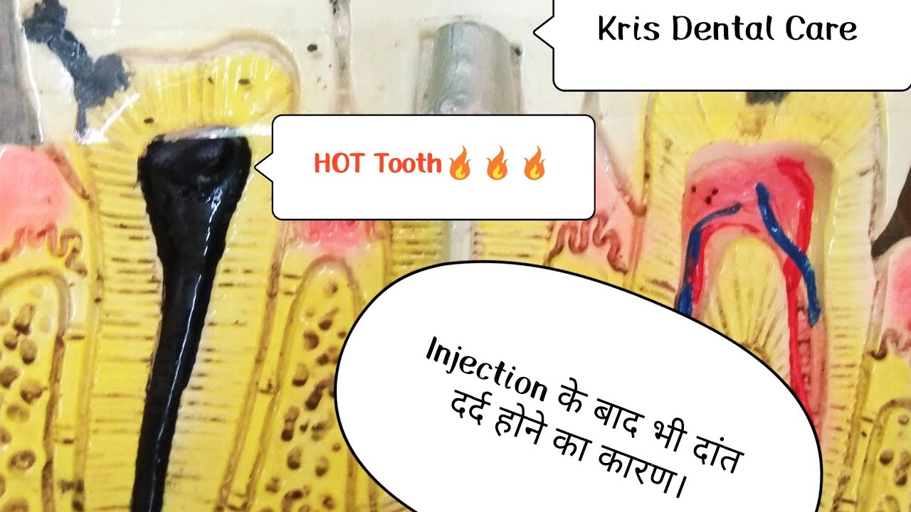 Hot tooth (Injection dene ke baad bhi dard hone ka kaaran) || #kris ...