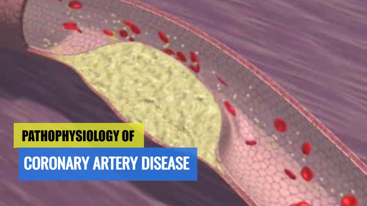 Pathophysiology of Coronary Artery Disease & ACS: Motion Animation ...