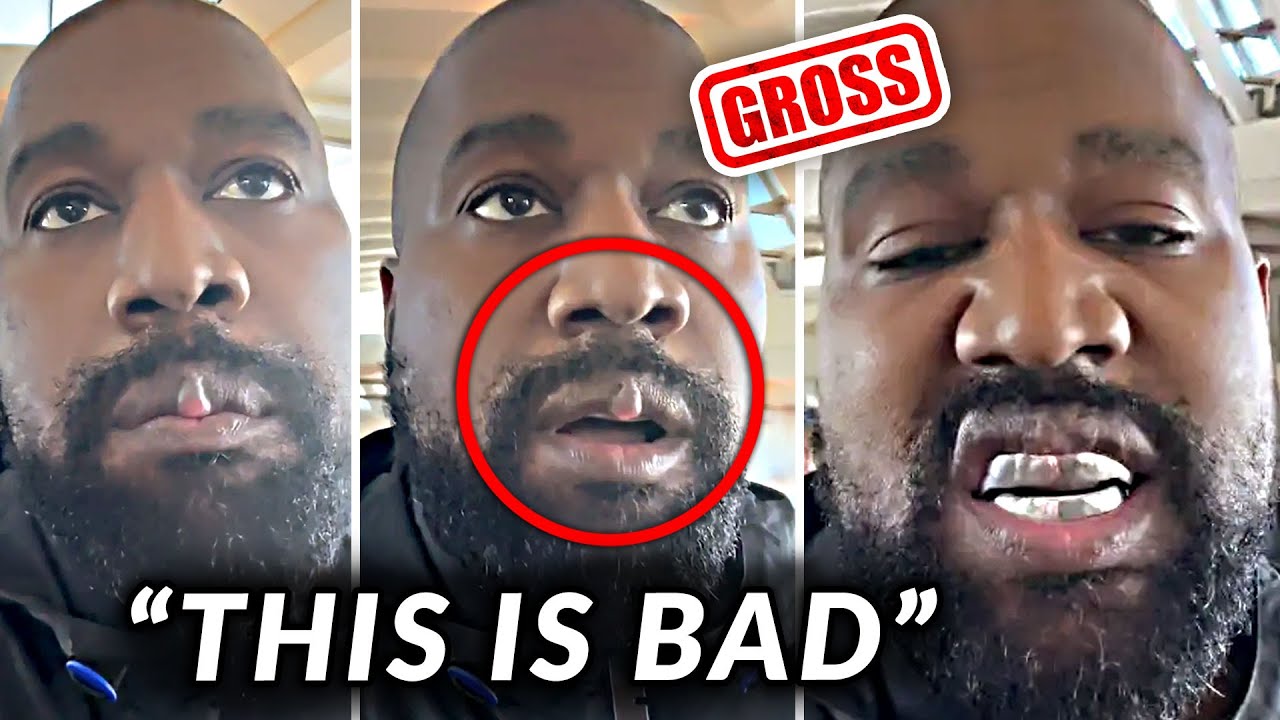 The Massive Growth On Kanye West's Upper Lip Is Concerning - YouTube