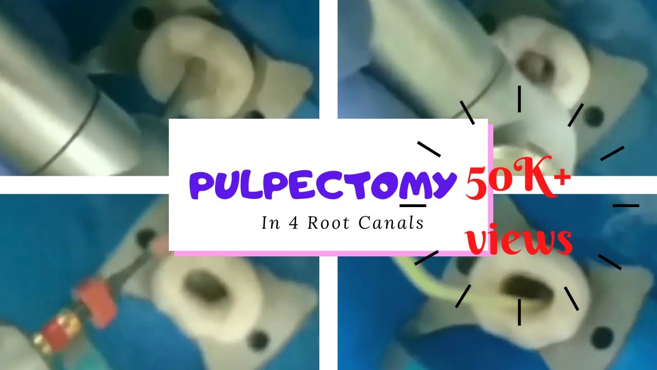 #pulpectomy PULPECTOMY STEP BY STEP||KEDO SG BLUE FILE||SINGLE SITTING ...