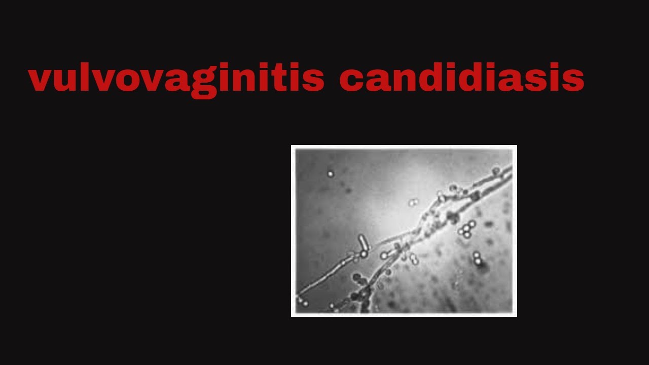 Vulvovaginitis
