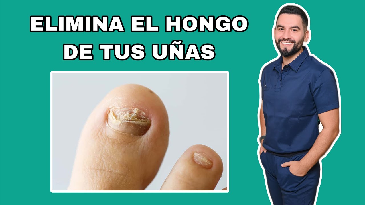 Tratamiento para eliminar el hongo en las uñas / Onicomicosis / Tiña ...