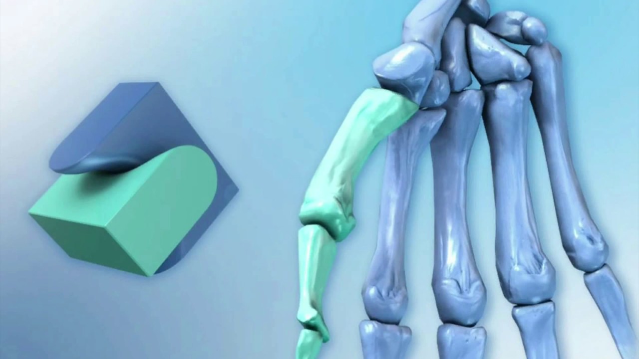 Rhizarthrose ou arthrose du pouce épisode 1/3 - YouTube