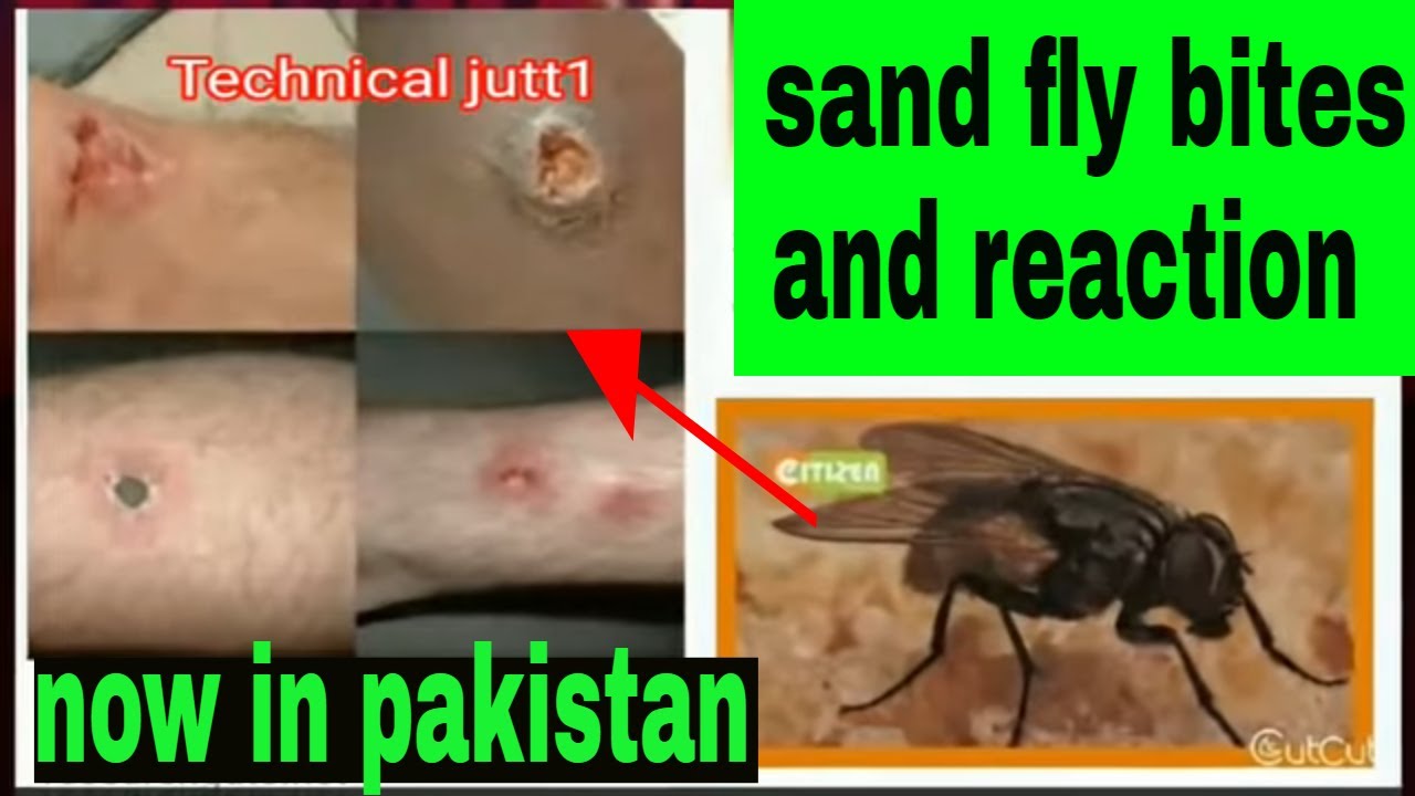 Sand fly bites /#flybites#technical jutt1#sandfly, - YouTube