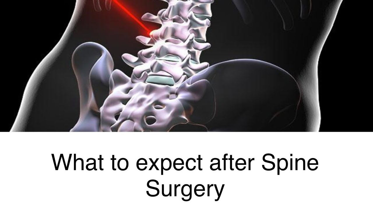 What to expect after spine surgery ?? Can you get back to normalcy ...